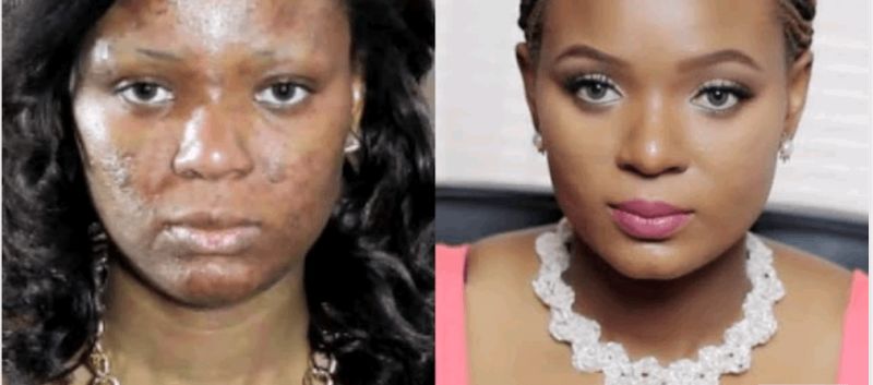 7 Best Soaps for Pimples & Dark Spots in Nigeria